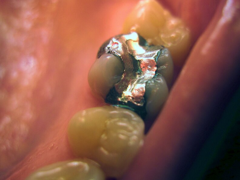 New Pill for Cavity Filling Heals Teeth Without Dentist Drill - Thrillist